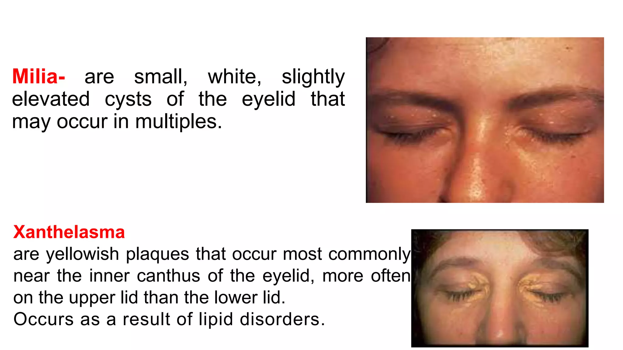 Eyelid disorders | PPTX