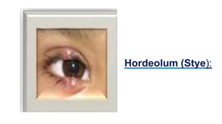 Eyelid disorders | PPTX