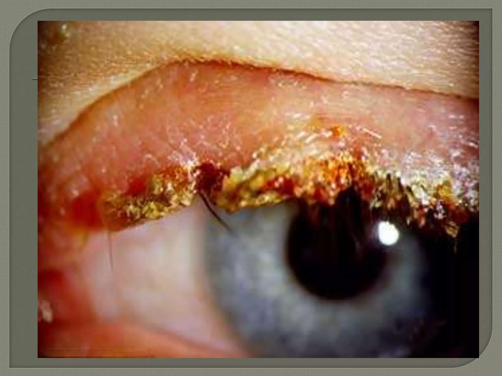 Eyelid Disorderspptx