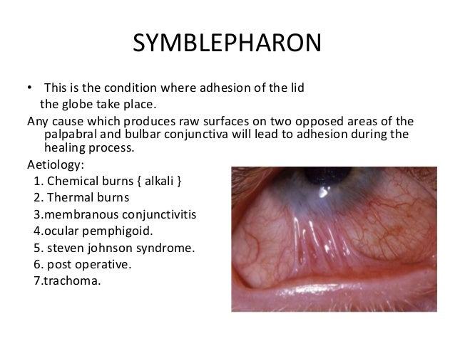 Eye lid i & ii 10.08.16