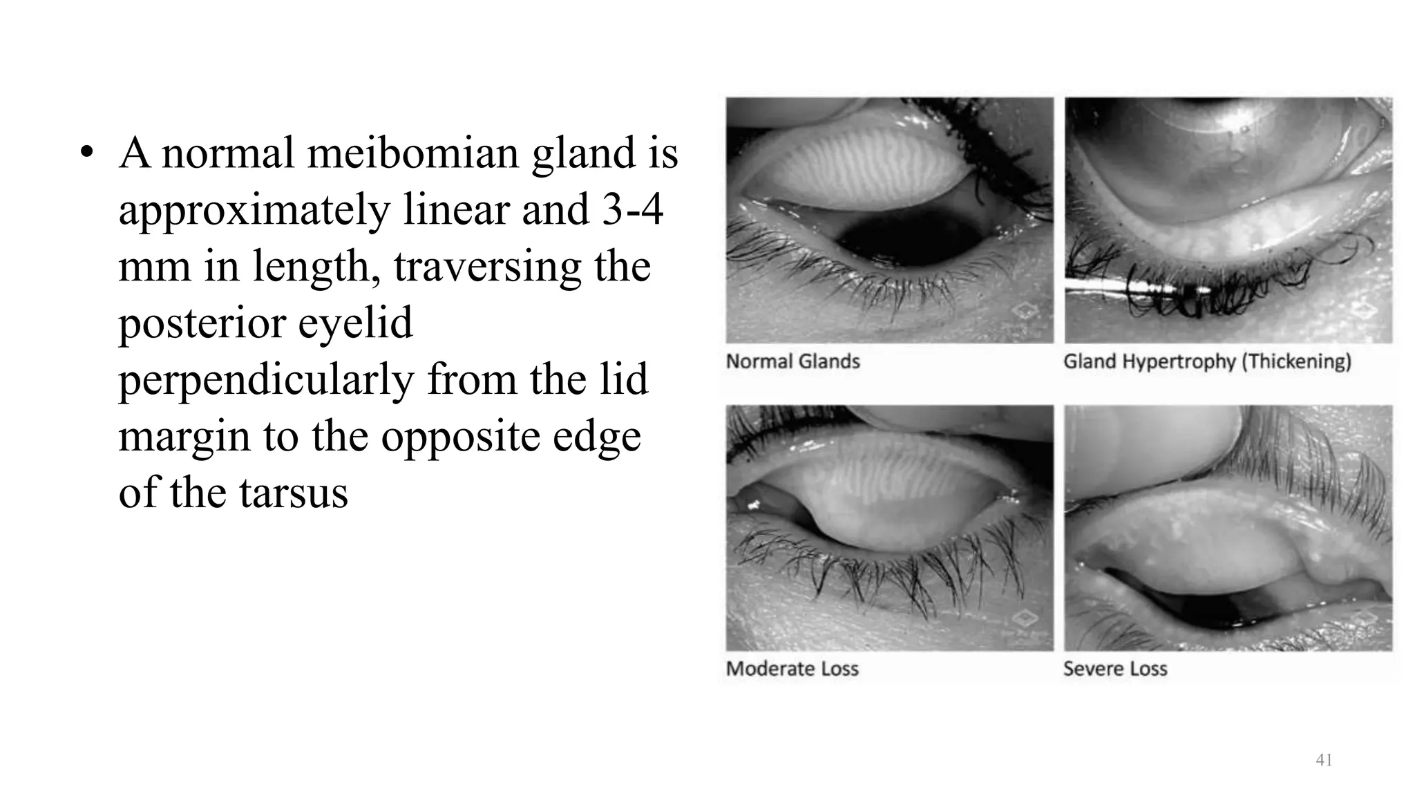 Eyelid Infections & Blepharitis Dr. Prabhat Devkota.pptx