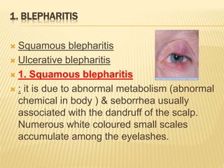 Squamous Blepharitis