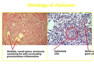 Chalazion Histology