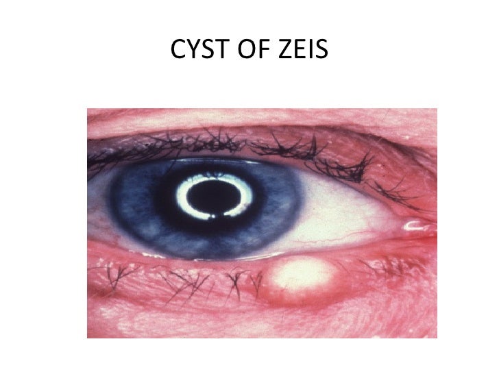 Eyelid inflammation & tumors