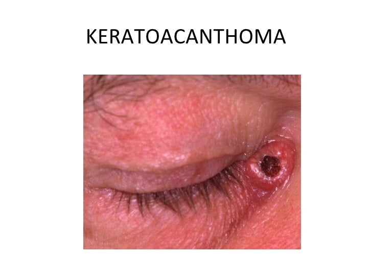 Eyelid inflammation & tumors