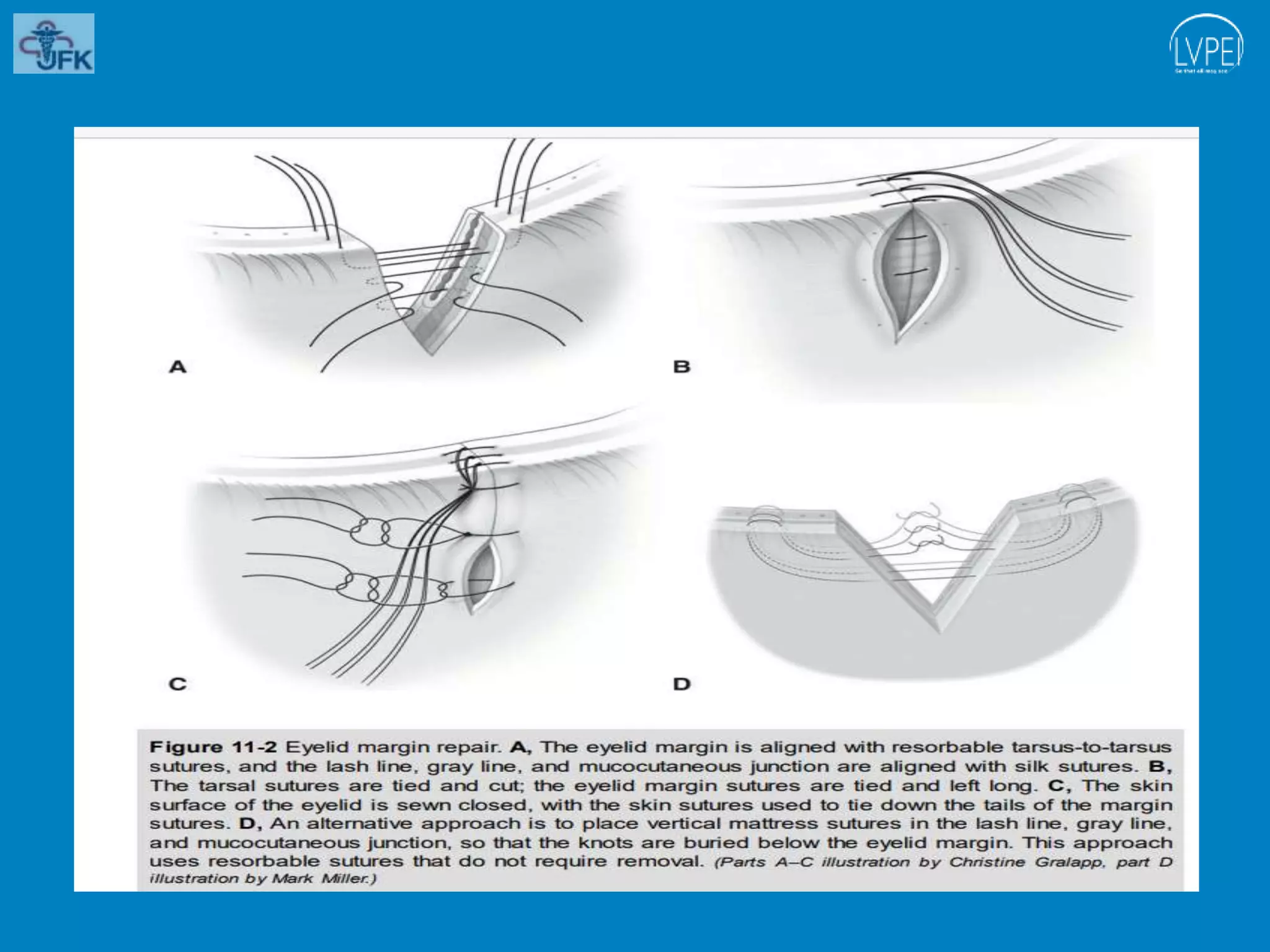 Eyelid laceration repair with defects.pptx