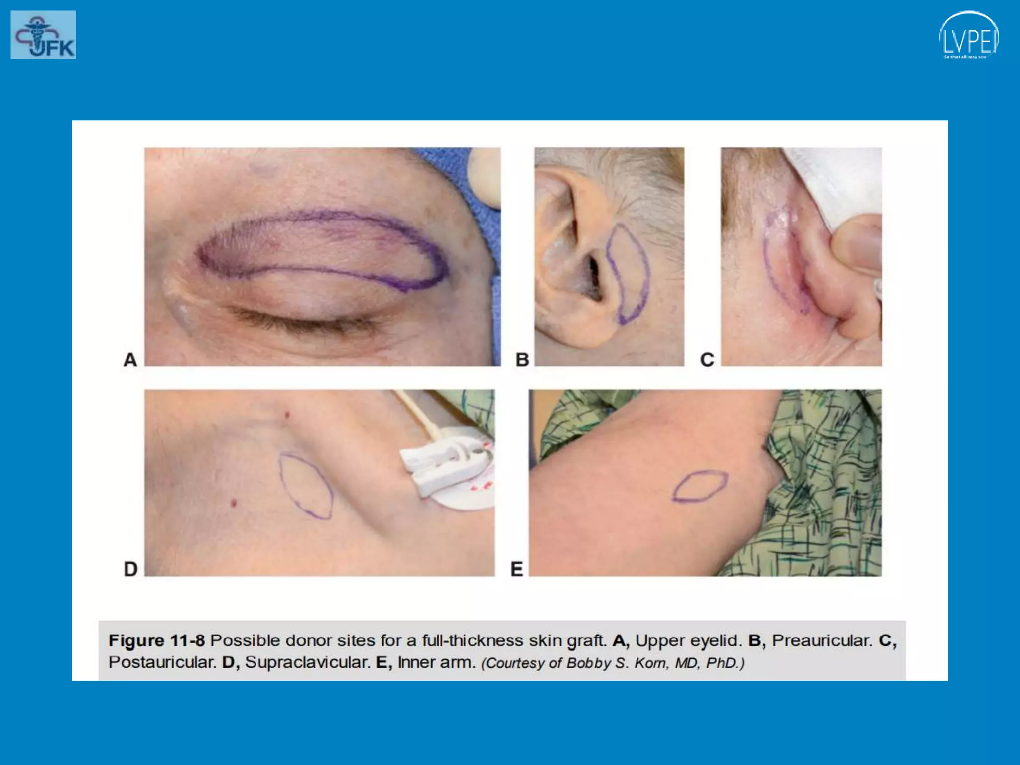 Eyelid laceration repair with defects.pptx