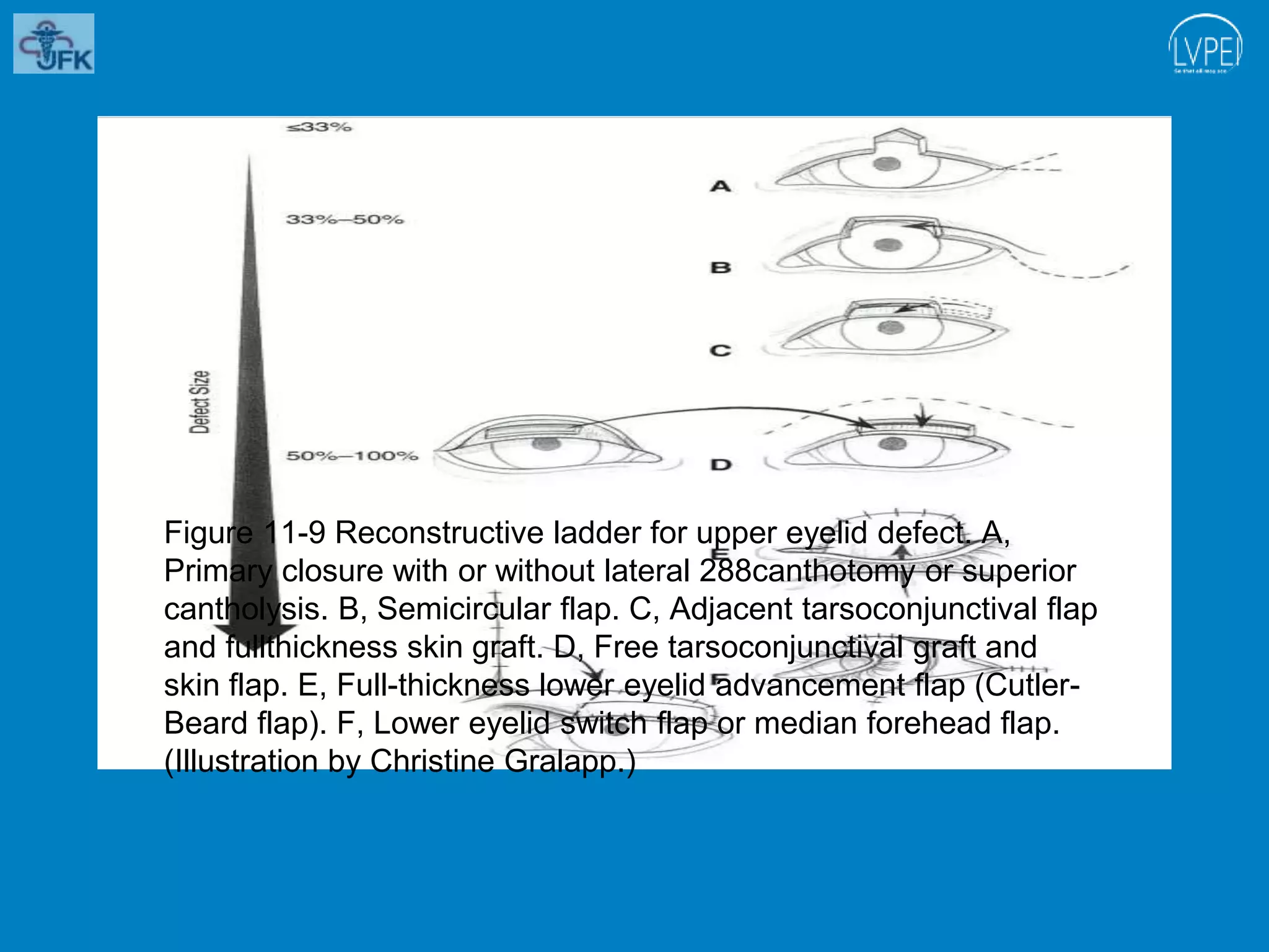 Eyelid laceration repair with defects.pptx
