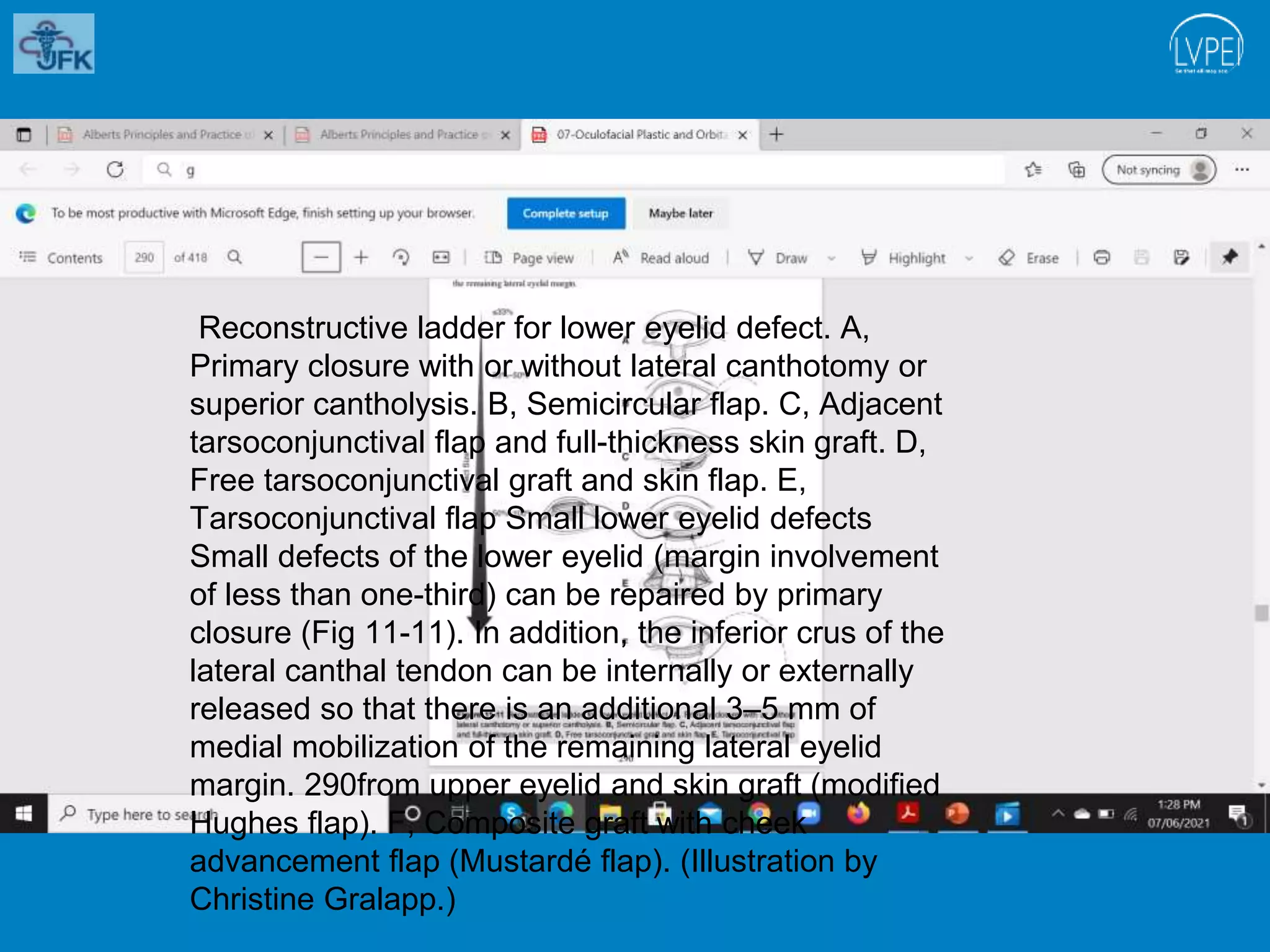 Eyelid laceration repair with defects.pptx