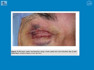 Eyelid laceration repair with defects.pptx