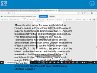 Eyelid laceration repair with defects.pptx