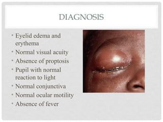 Eyelid, lacrimal (1) ophthalmology slide | PPT