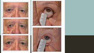Eyelid, Lacrimal System, and Orbital Examination (1).pptx
