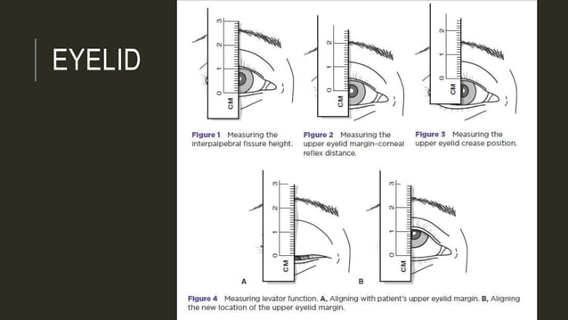 Eyelid, Lacrimal System, and Orbital Examination (1).pptx