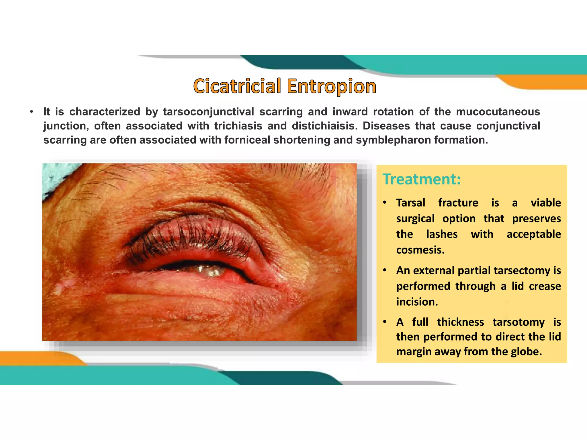 Eyelid malposition | PPTX