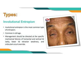 Eyelid malposition | PPTX