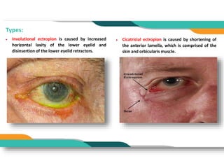 Eyelid malposition | PPTX