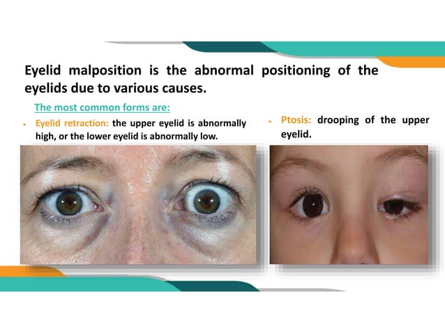Eyelid malposition | PPTX