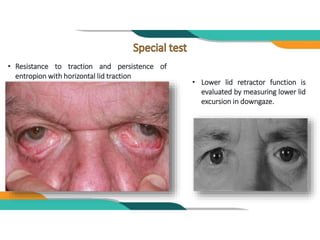 Eyelid malposition | PPTX