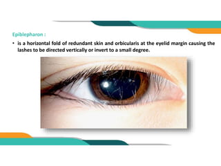 Eyelid malposition | PPTX