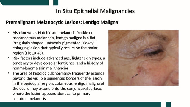 Eyelid Neoplasms aao reading pediatrik oftalmologi | PPT