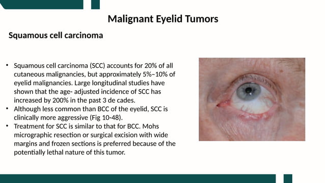 Eyelid Neoplasms aao reading pediatrik oftalmologi | PPT