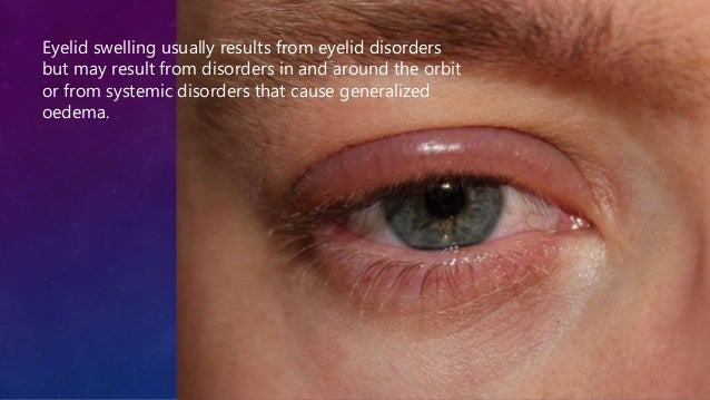 Eyelid oedema - A brief review
