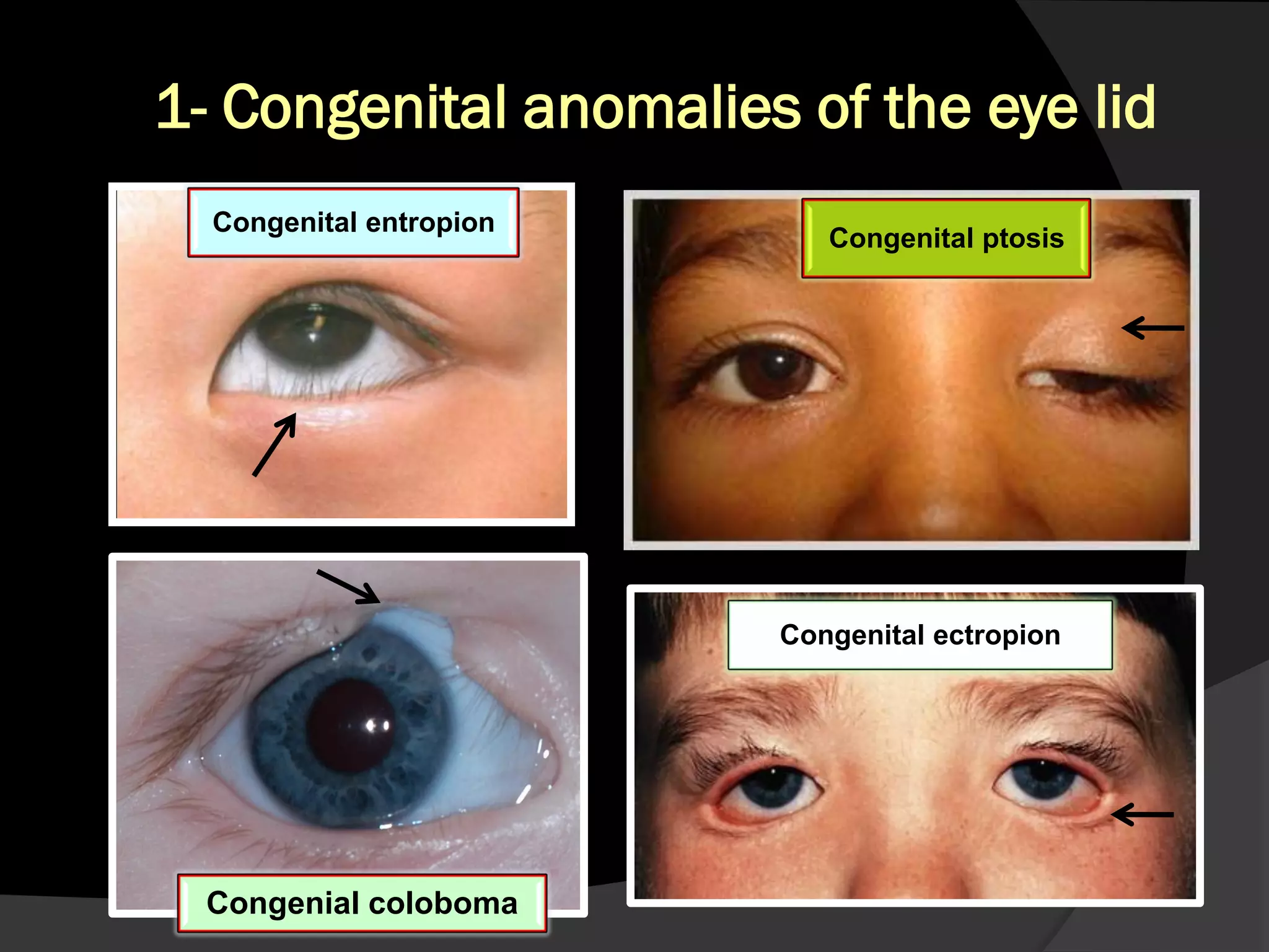 Eyelid pathology 1 | PDF