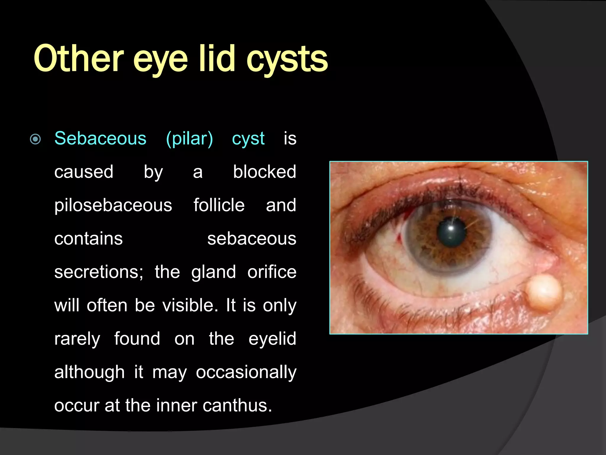 Eyelid pathology 1 | PDF