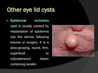 Eyelid pathology 1 | PDF