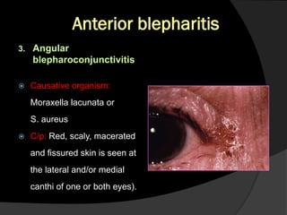 Angular Blepharoconjunctivitis
