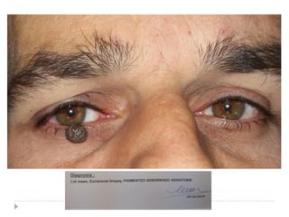 Intradermal Nevus Eyelid