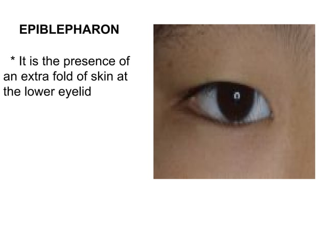 Eyelid pathology baguio2012 | PPT