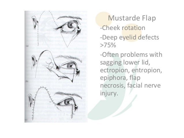 Eyelid Recon