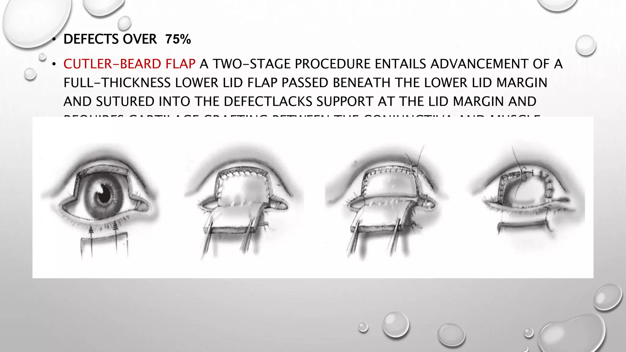 Eyelid reconstraction | PPTX