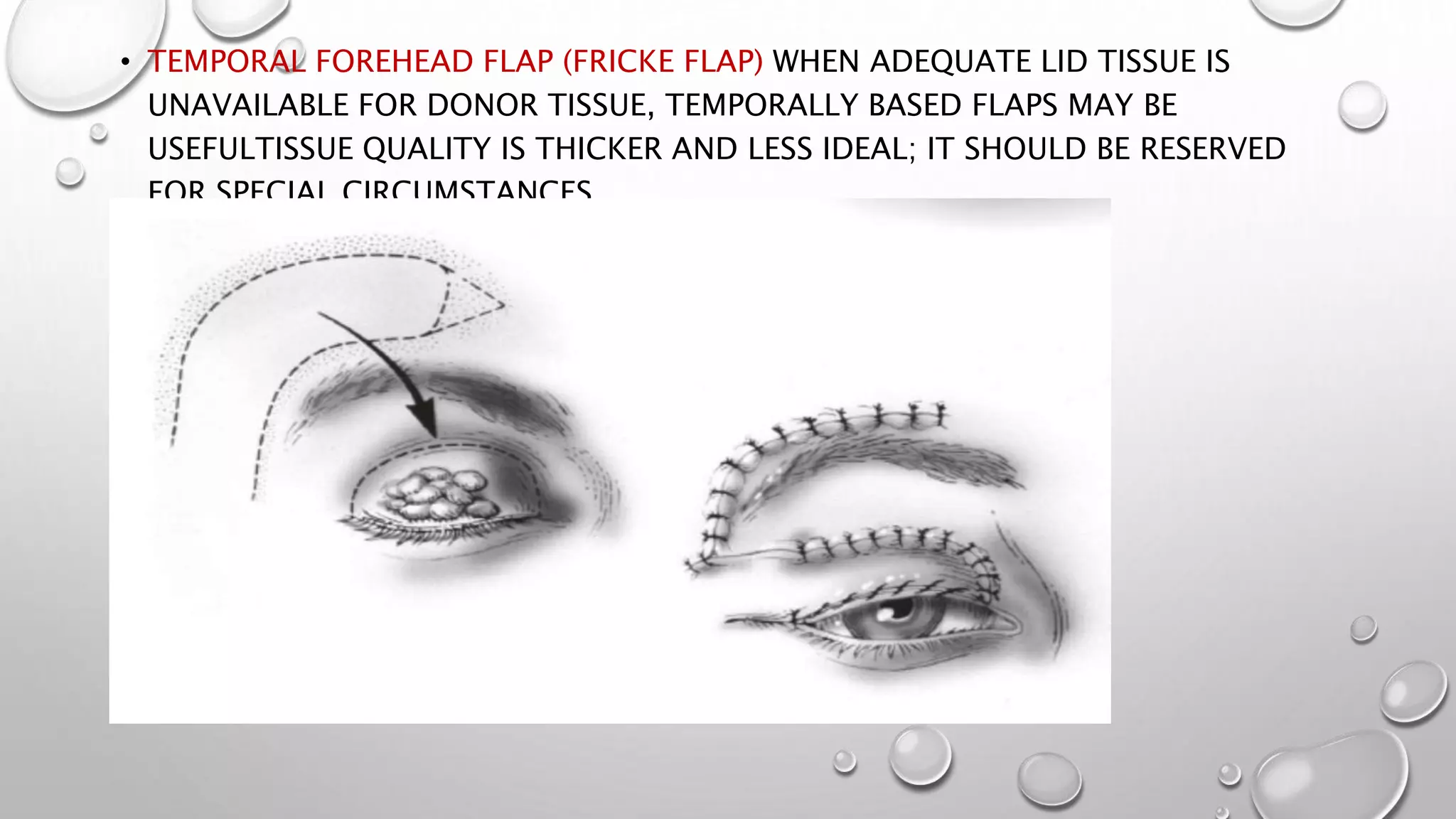 Eyelid reconstraction | PPTX