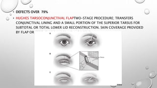 Eyelid reconstraction | PPTX