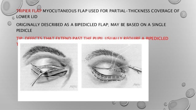 Eyelid Reconstraction