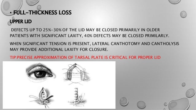 Eyelid reconstraction