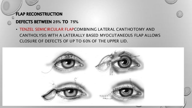 Eyelid Reconstraction
