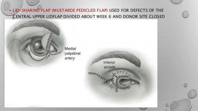 Eyelid reconstraction