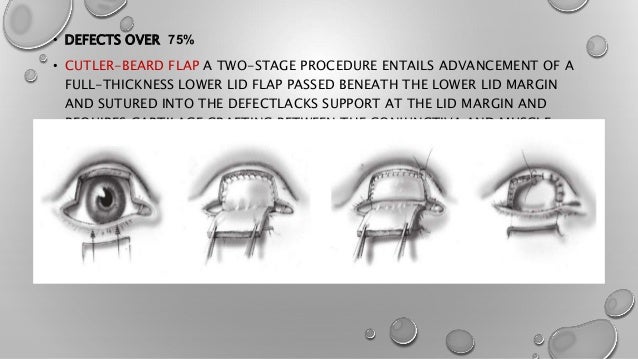 Eyelid Reconstraction