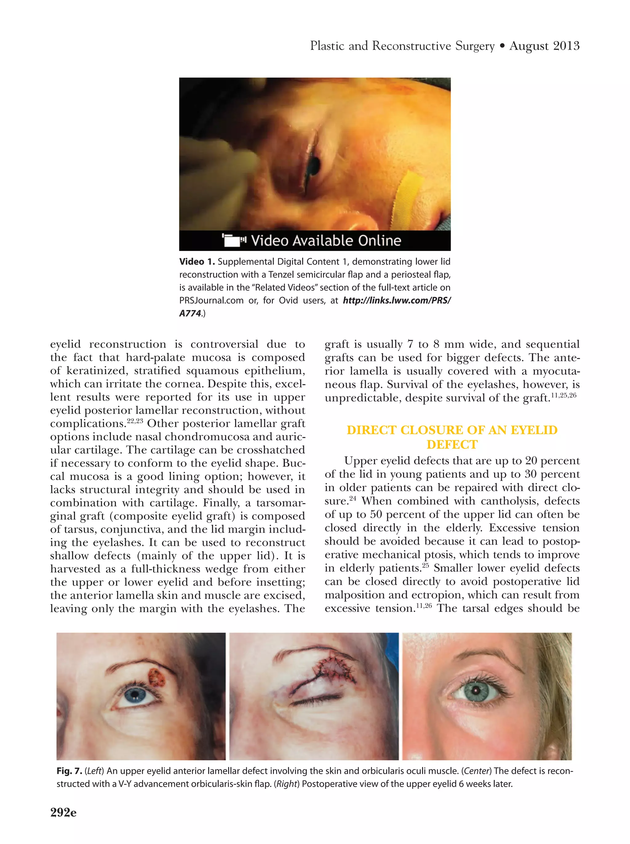 Eyelid Reconstruction CME Article Dr. McClellan | PDF