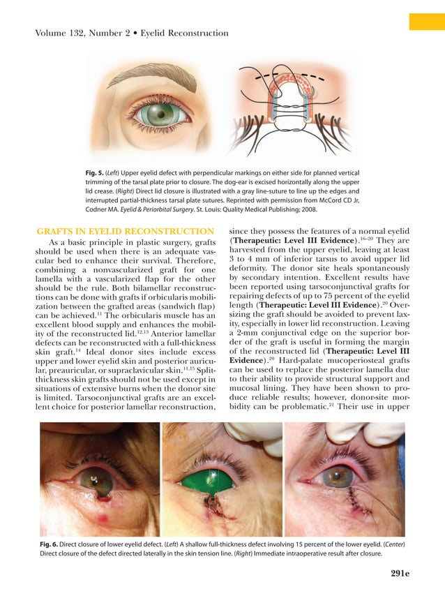 Eyelid Reconstruction CME Article Dr. McClellan | PDF | Eye and Vision ...