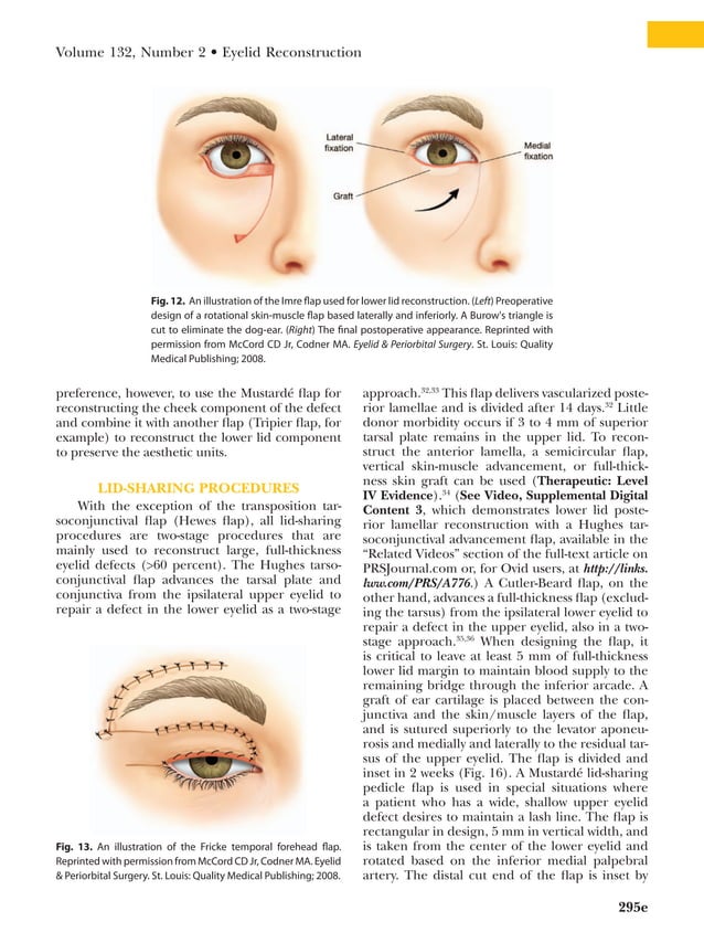 Eyelid Reconstruction CME Article Dr. McClellan | PDF | Eye and Vision ...