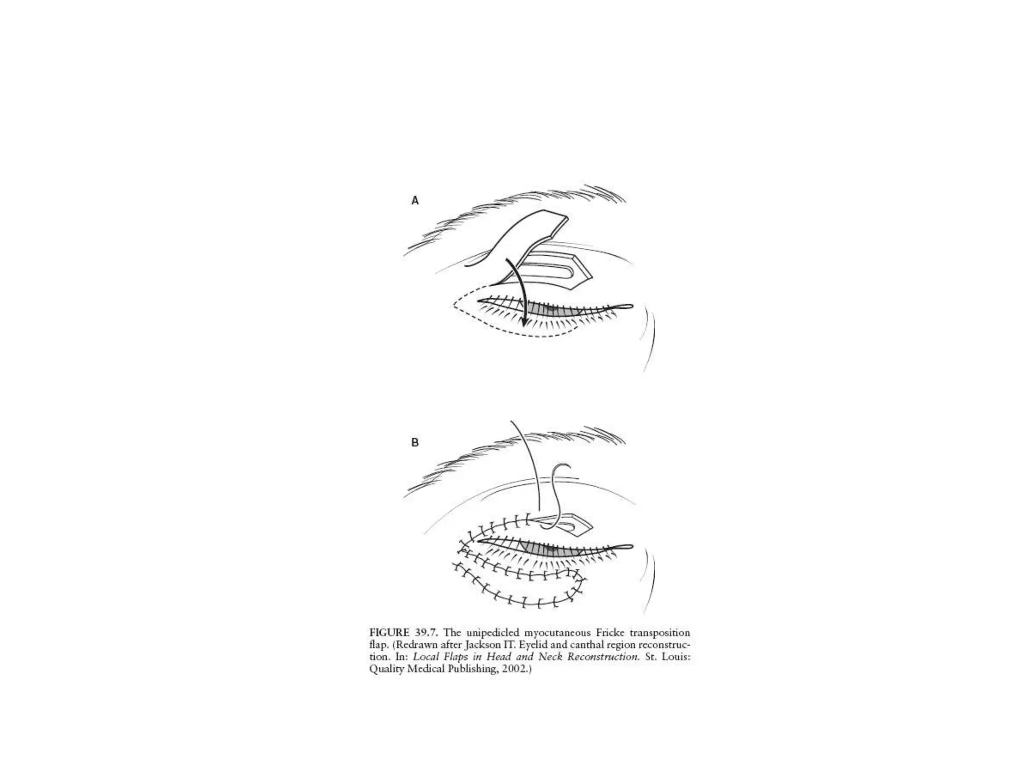 Eyelid reconstruction | PPTX