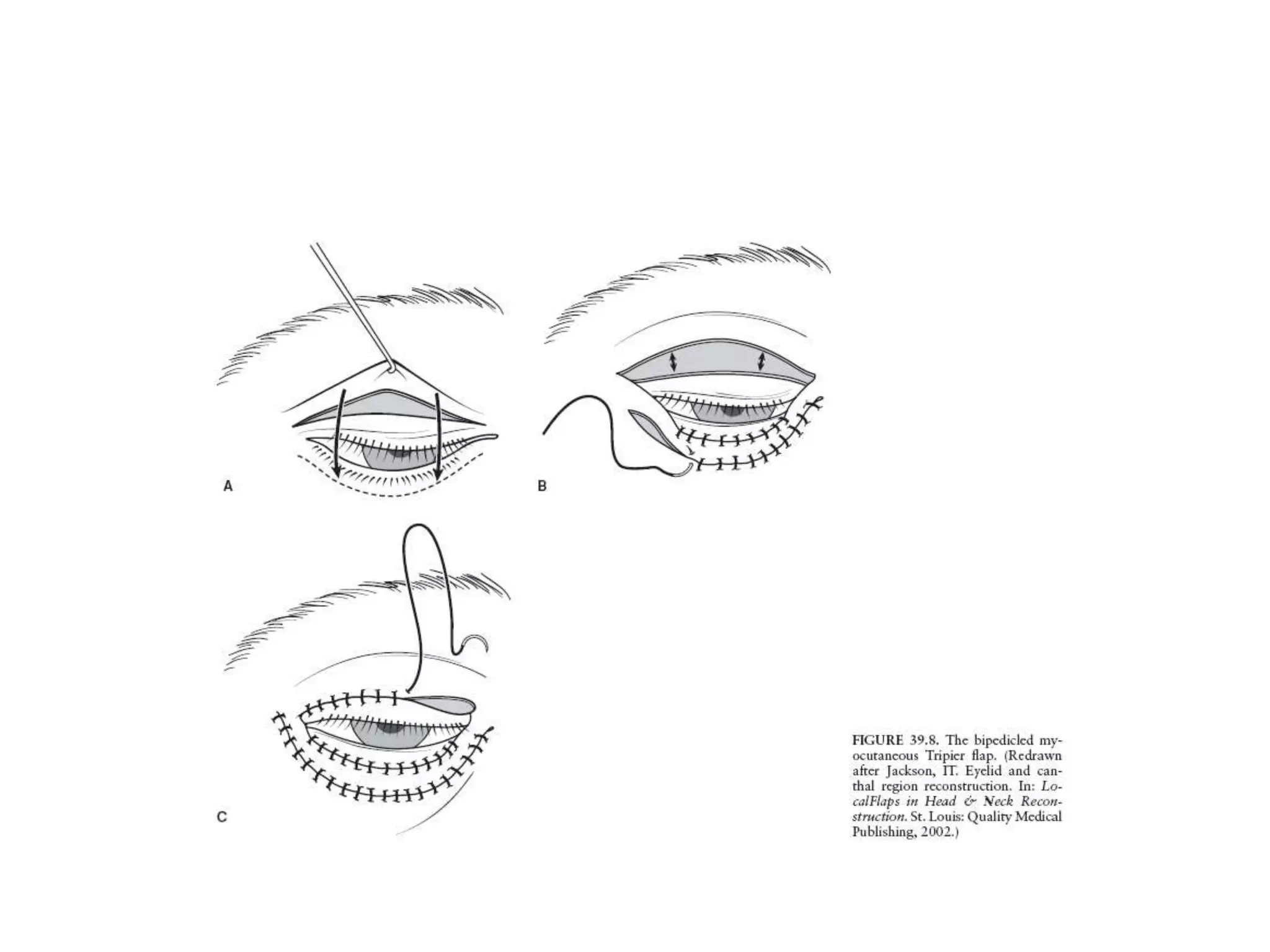 Eyelid reconstruction | PPTX