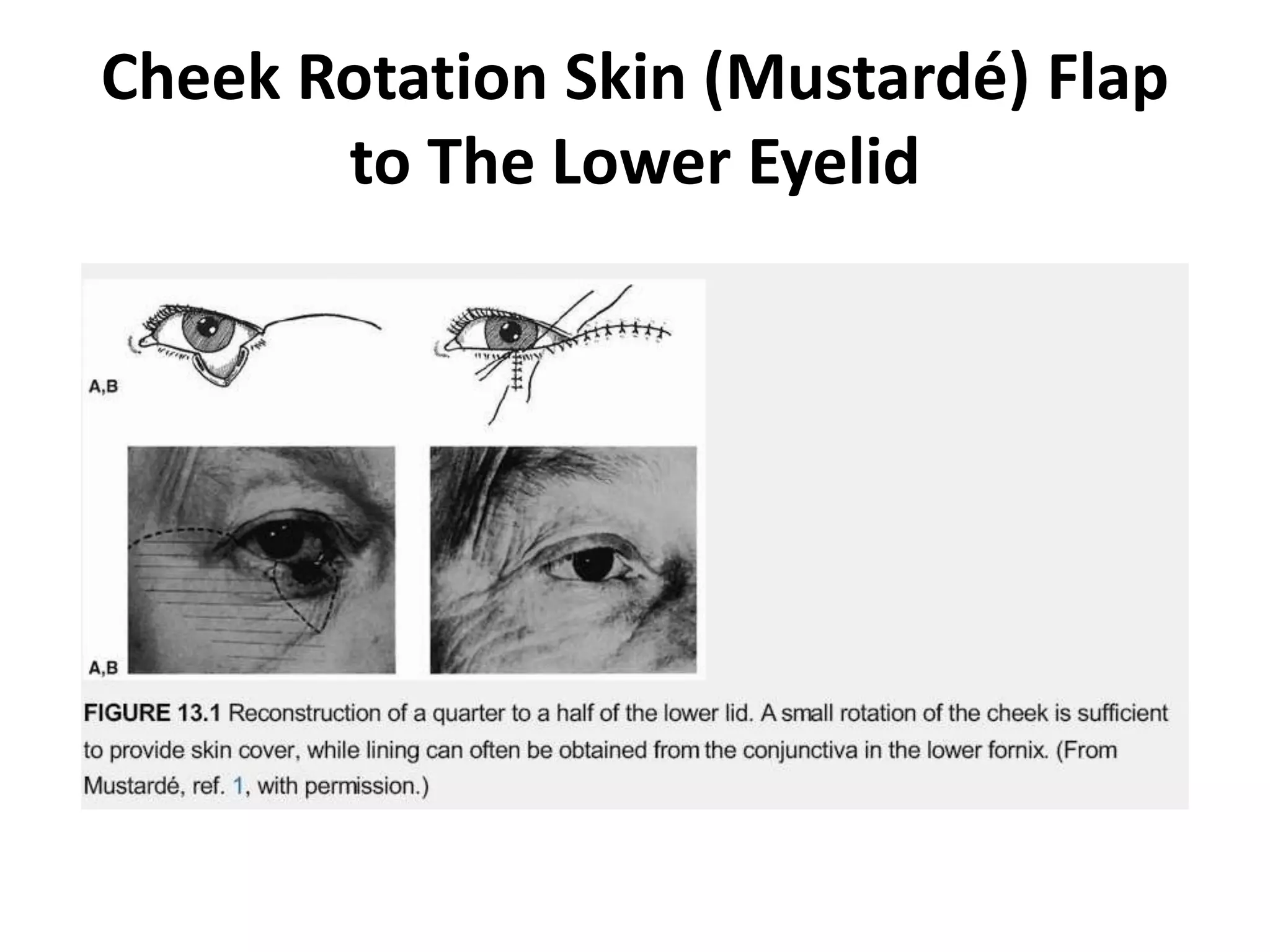 Eyelid reconstruction | PPTX