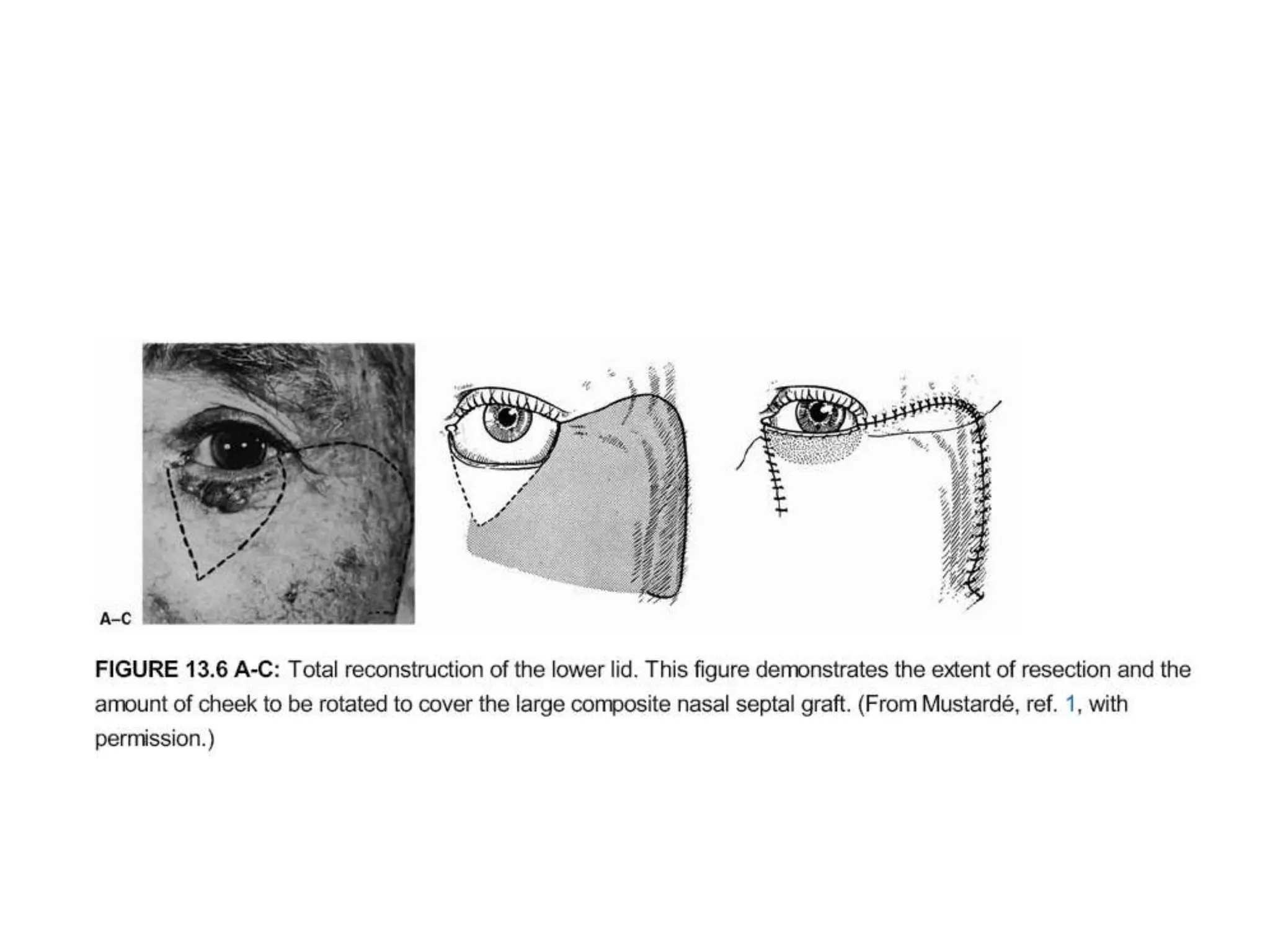 Eyelid reconstruction | PPTX