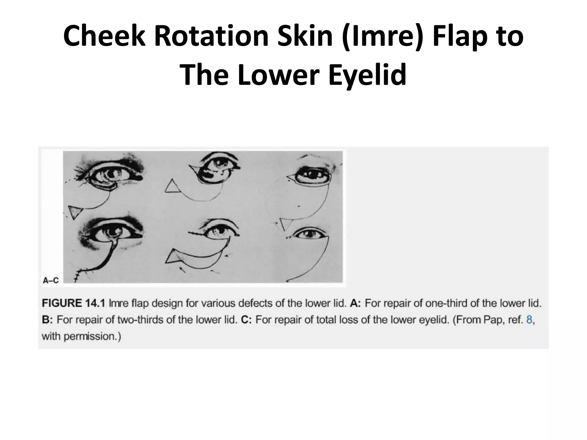 Eyelid reconstruction | PPTX